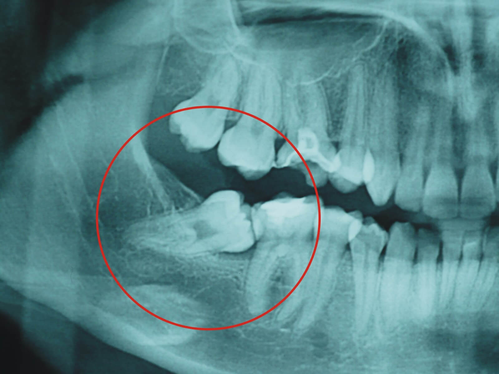 Extracción de las muelas del juicio | Clínica Dental Mireia Espinosa